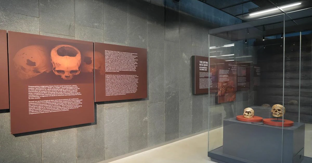 Anatolian skull operated on 5,000 years ago attracts attention ...